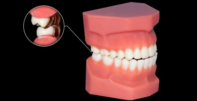 Before and After Teeth Grinding: Restoring Your Smile